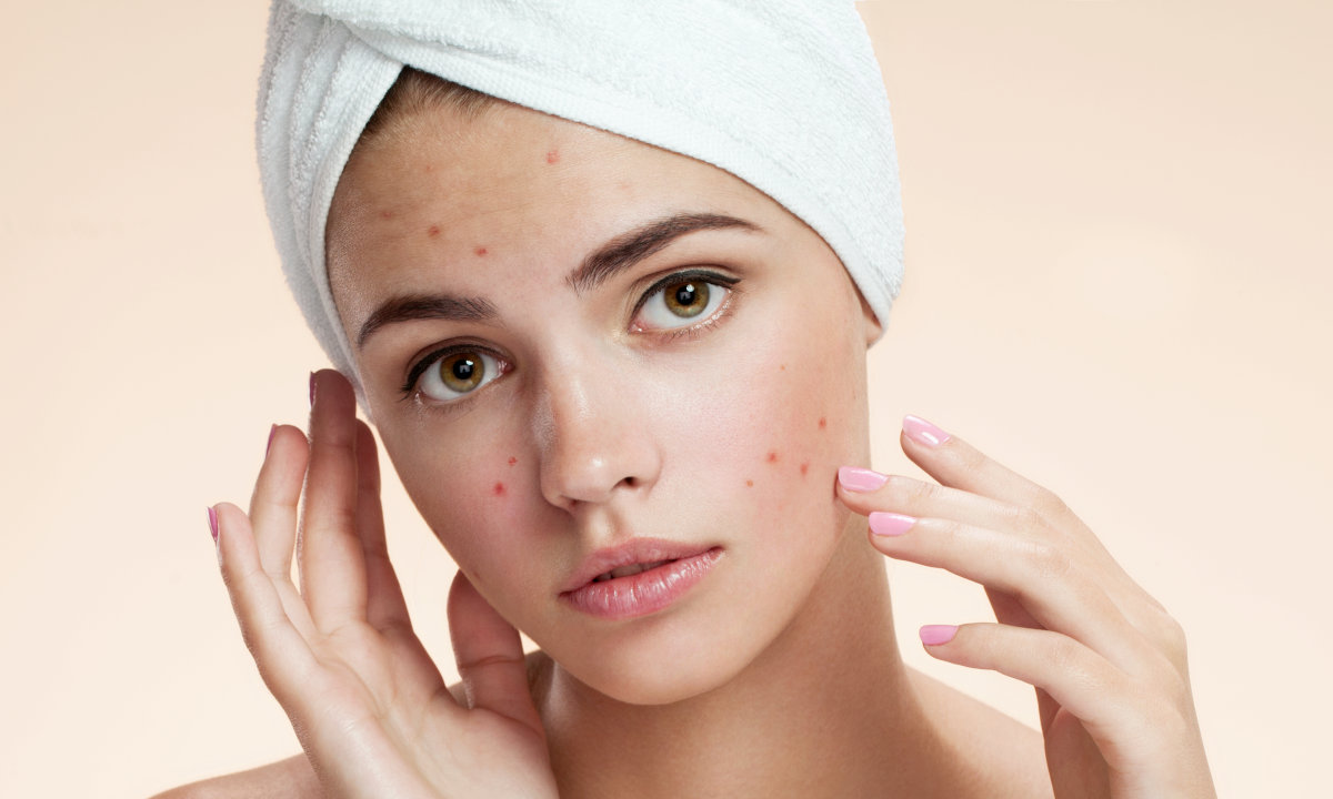 Skin purging: cos'è e come riconoscerlo - Beautydea